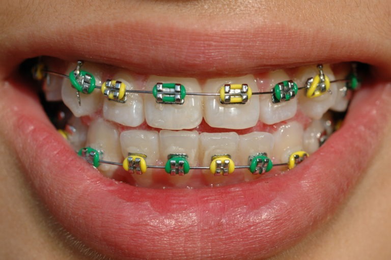How to Choose the Best Braces Colors | Dudley Smiles